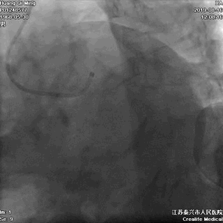 耿宝玉：CCTA指导左冠前降支无植入介入操作一例 -- 严道医声网